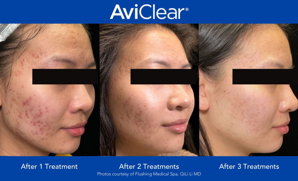 Acne Dermatologist Melbourne | Northside Dermatology