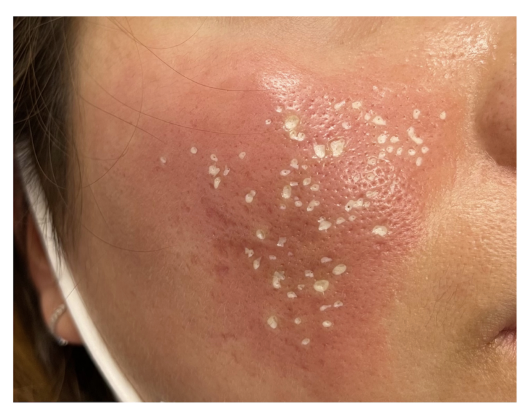 TCA Cross Treatment Melbourne | Northside Dermatology