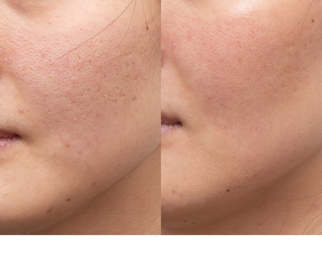 TCA Cross Treatment Melbourne | Northside Dermatology