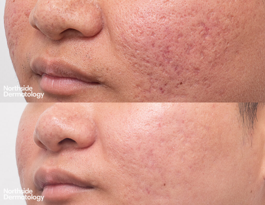 CO2 Laser Resurfacing | Northside Dermatology