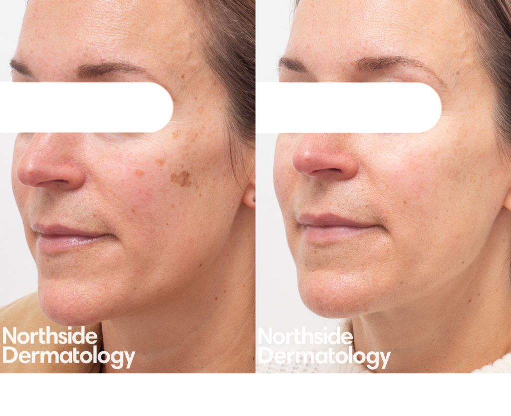 Q-Switched Laser Melbourne | Northside Dermatology