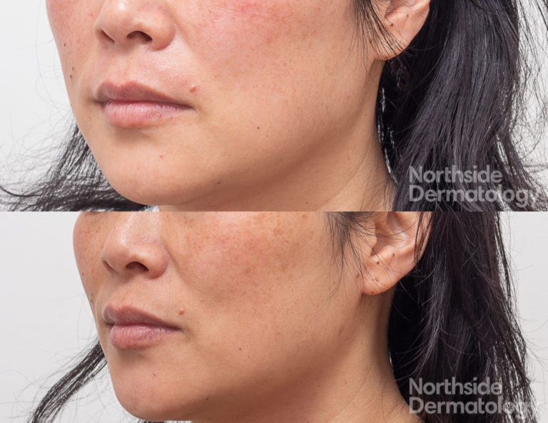 Ultraformer III Melbourne | Northside Dermatology