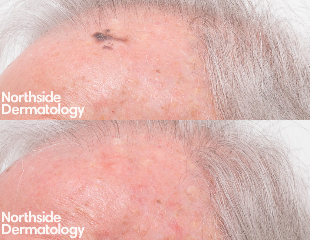 Co2 Laser Resurfacing Northside Dermatology
