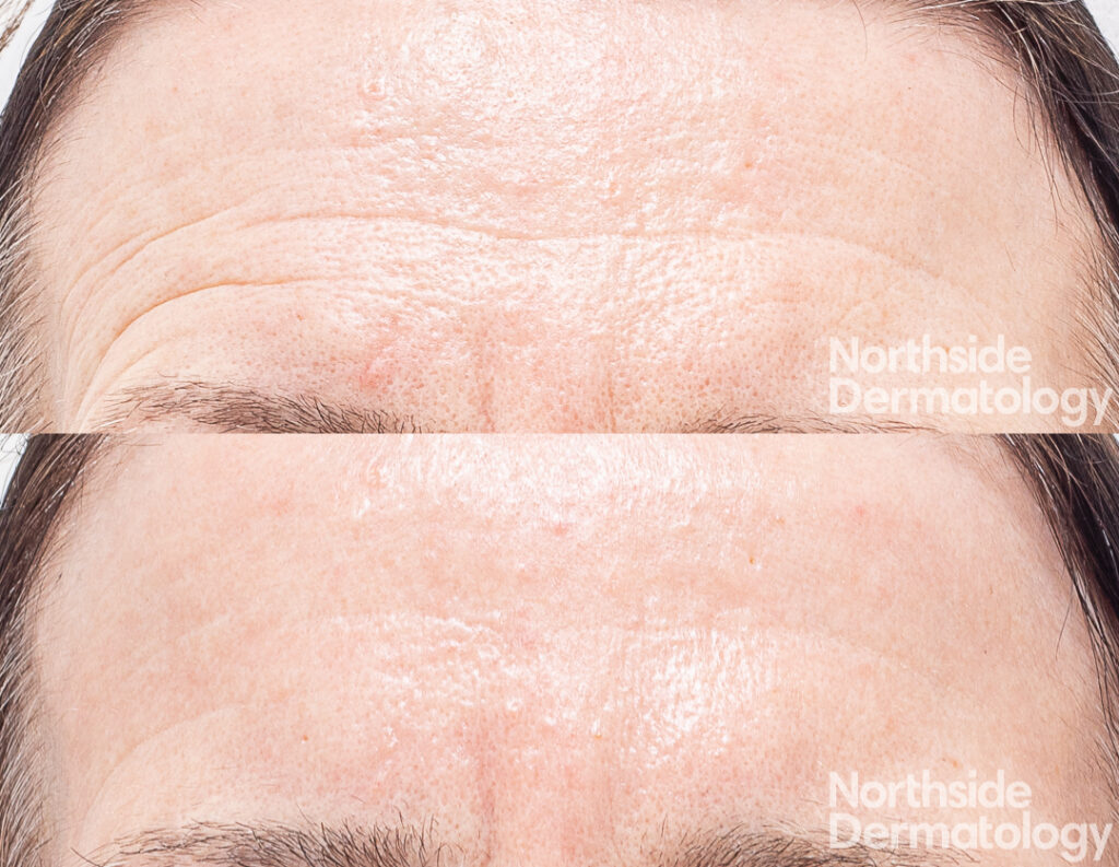 Co2 Laser Resurfacing Northside Dermatology