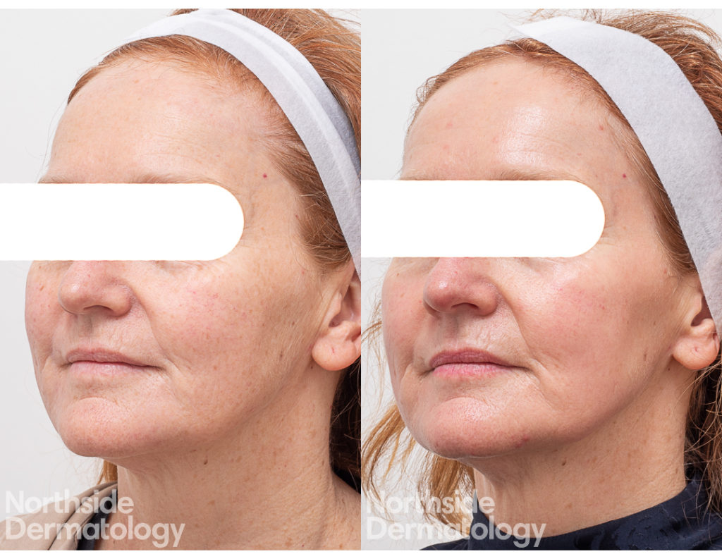 LaseMD Treatment Melbourne | Northside Dermatology