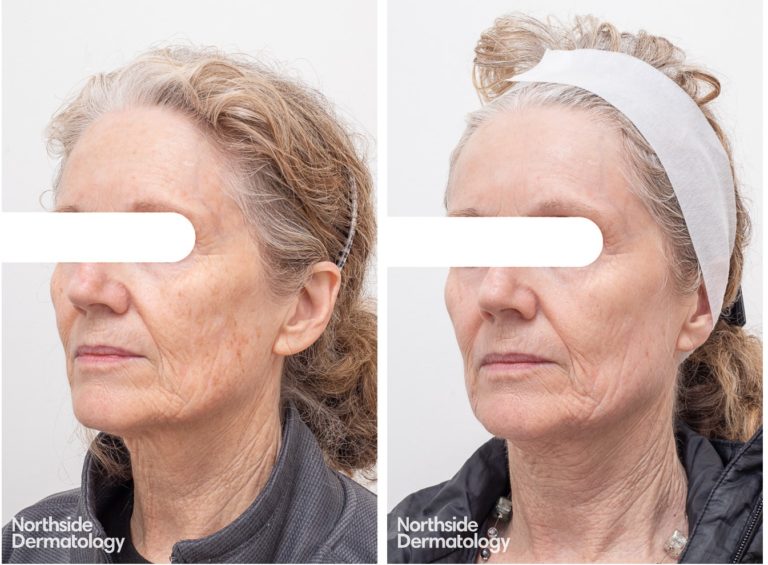 LaseMD Treatment Melbourne | Northside Dermatology
