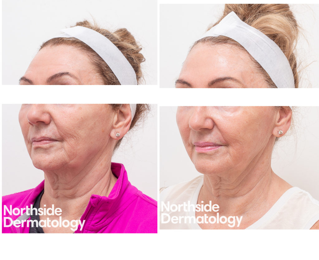 CO2 Laser Resurfacing | Northside Dermatology