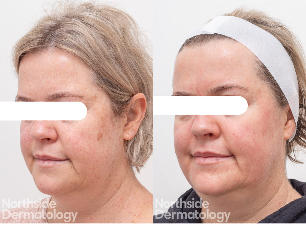 LaseMD Treatment Melbourne | Northside Dermatology