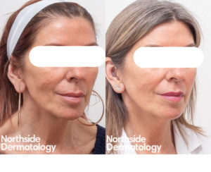 LaseMD Treatment Melbourne | Northside Dermatology