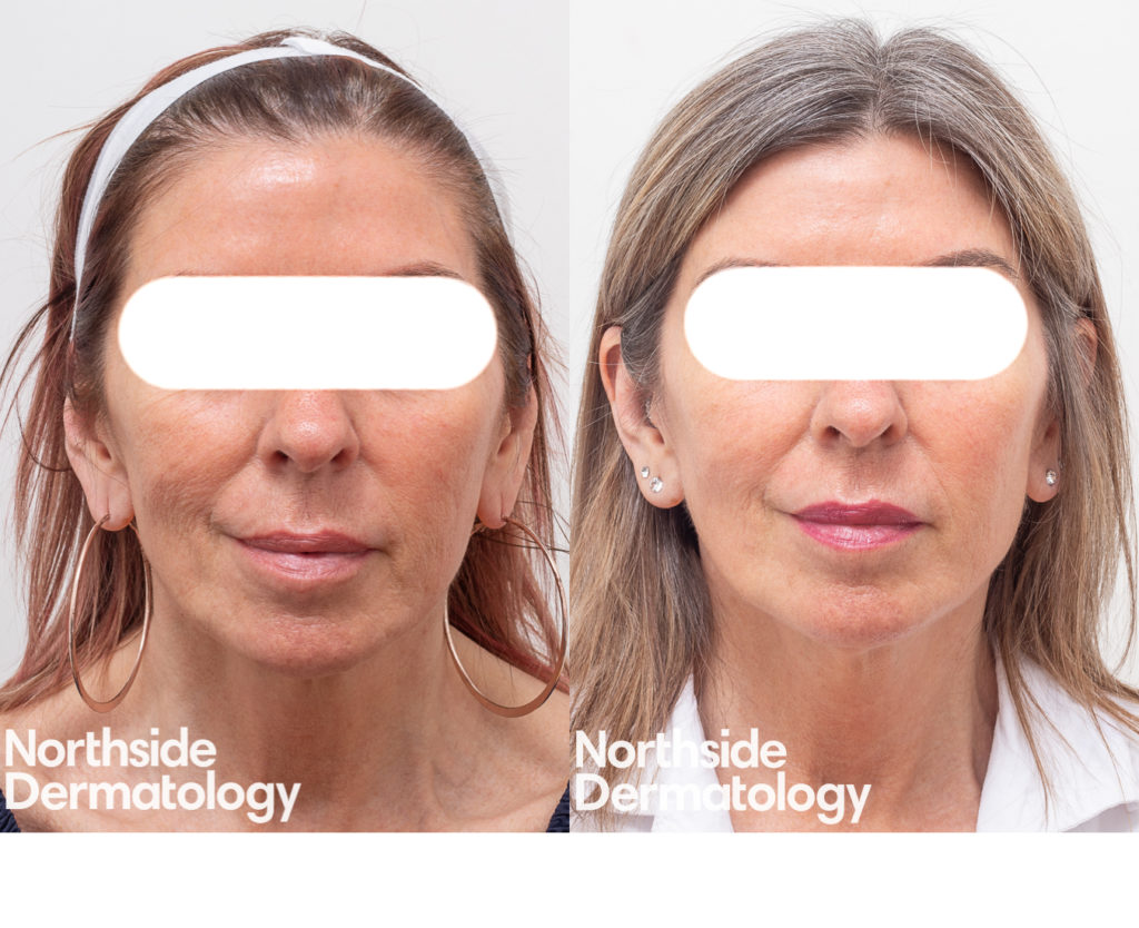 LaseMD Treatment Melbourne | Northside Dermatology