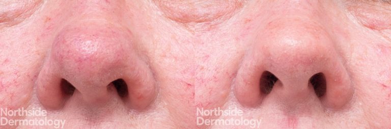 Rosacea Treatment Melbourne | Northside Dermatology