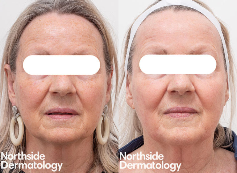 LaseMD Treatment Melbourne | Northside Dermatology