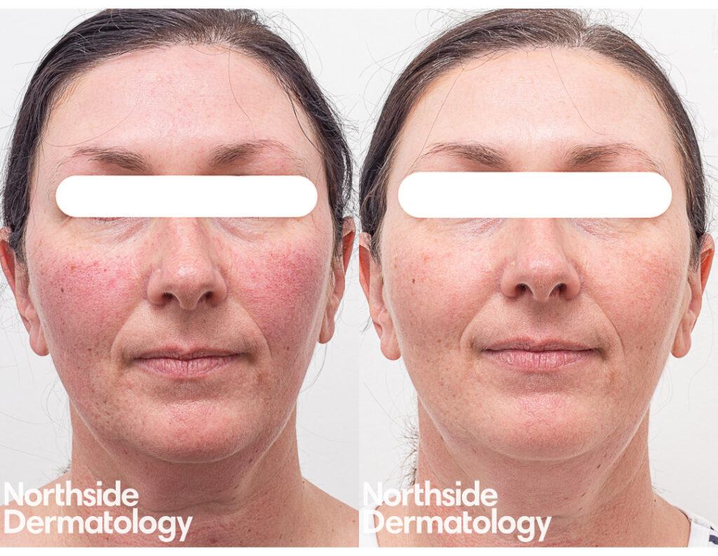 Rosacea Treatment Melbourne | Northside Dermatology