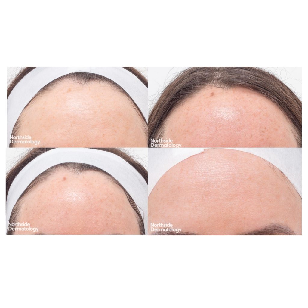 LaseMD Treatment Melbourne | Northside Dermatology