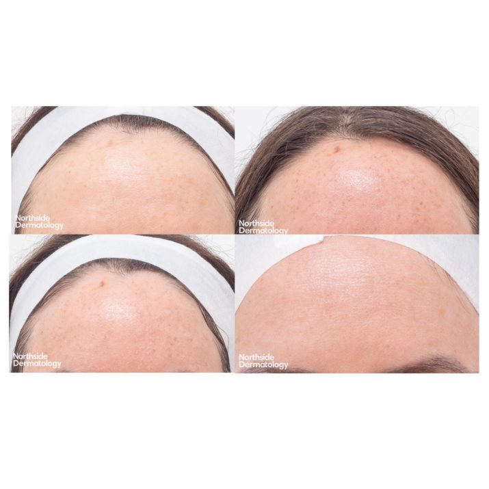 LaseMD Treatment Melbourne | Northside Dermatology