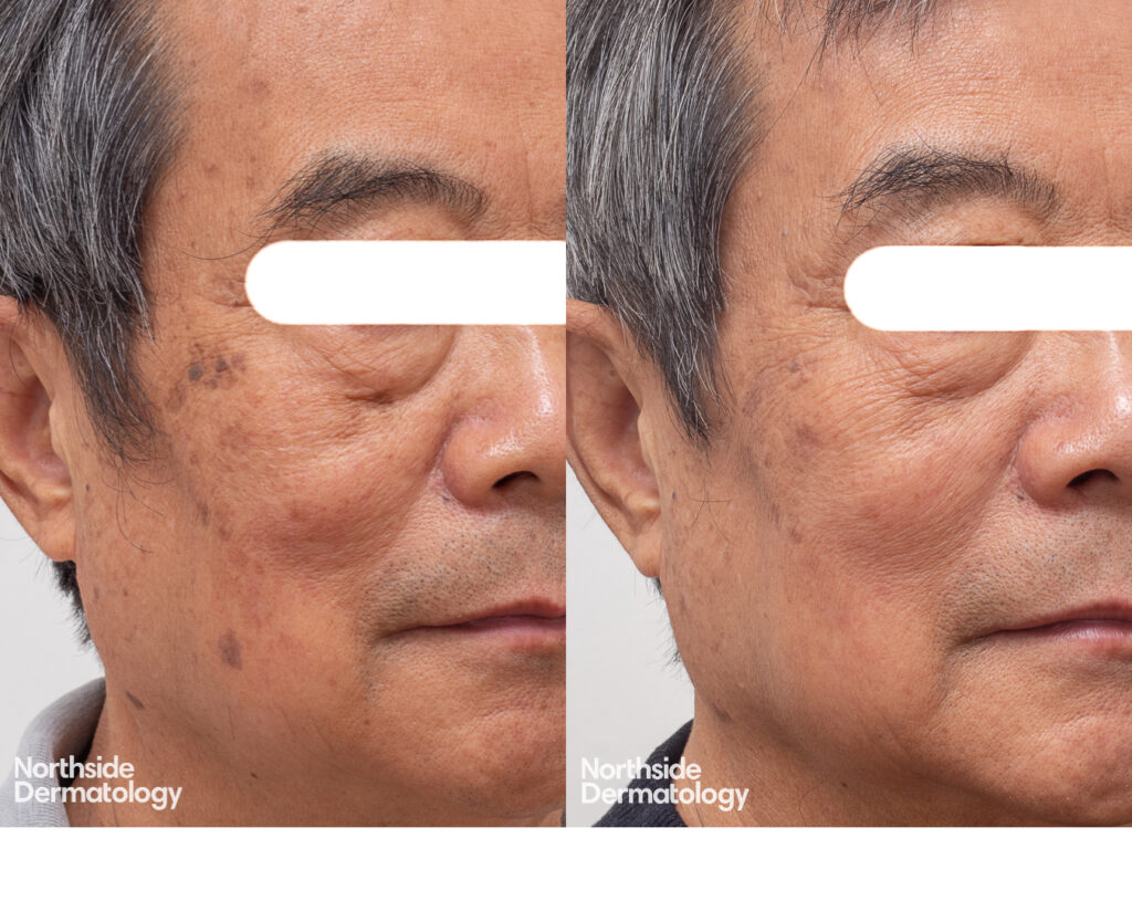 PicoSure Pro Laser Melbourne | Northside Dermatology