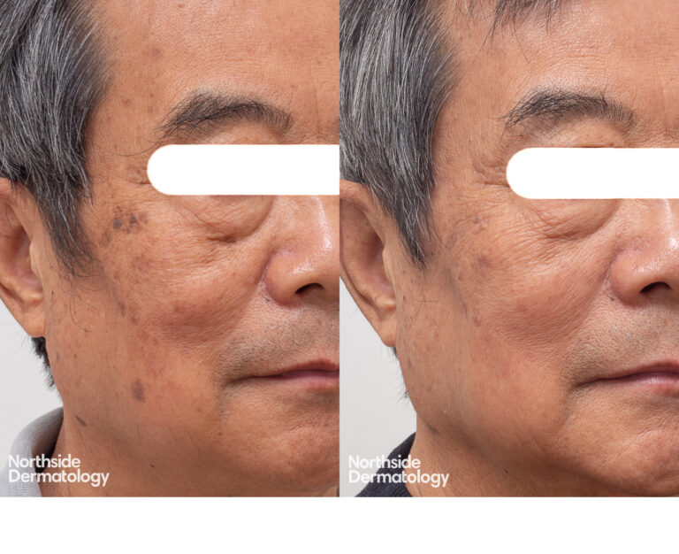 PicoSure Pro Laser Melbourne | Northside Dermatology