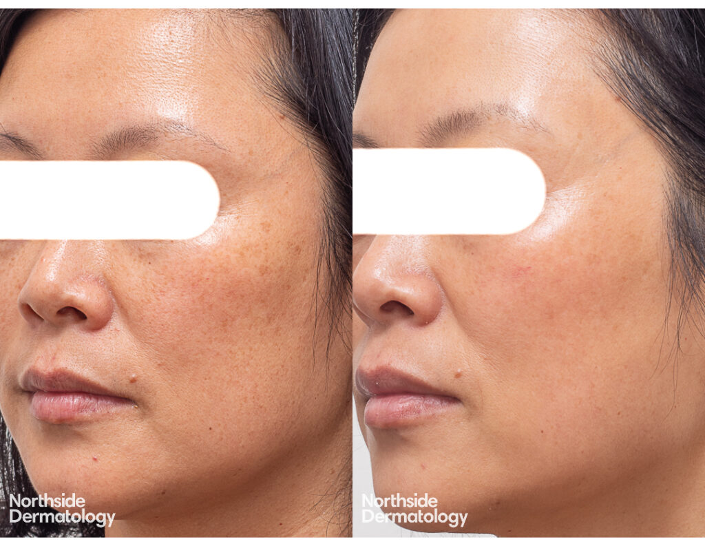 PicoSure Pro Laser Melbourne | Northside Dermatology