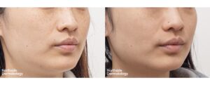PicoSure Pro Laser Melbourne | Northside Dermatology