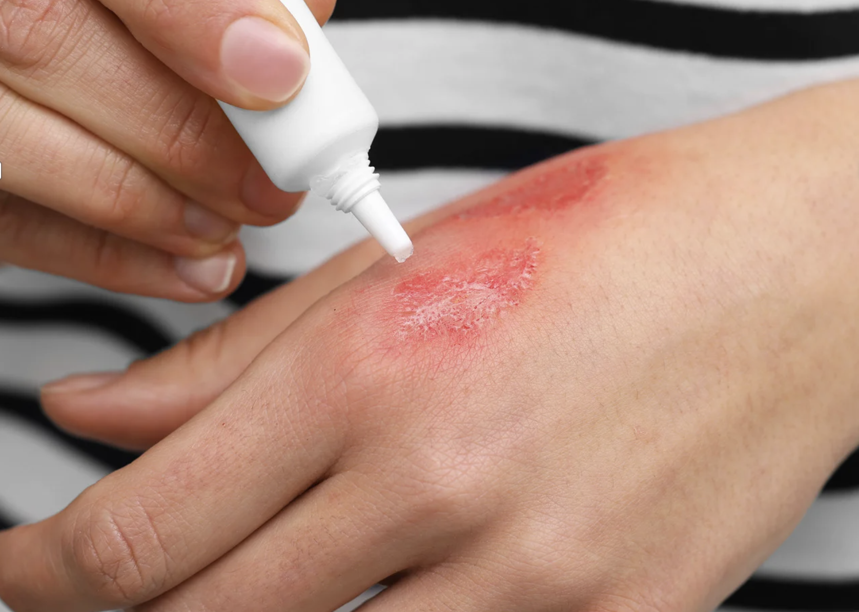 Burn Scars Treatment Melbourne | Northside Dermatology
